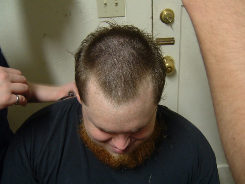 Emergency options for men going bald - Get a First Life